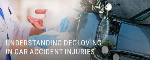 Understanding Degloving in Car Accident Injuries